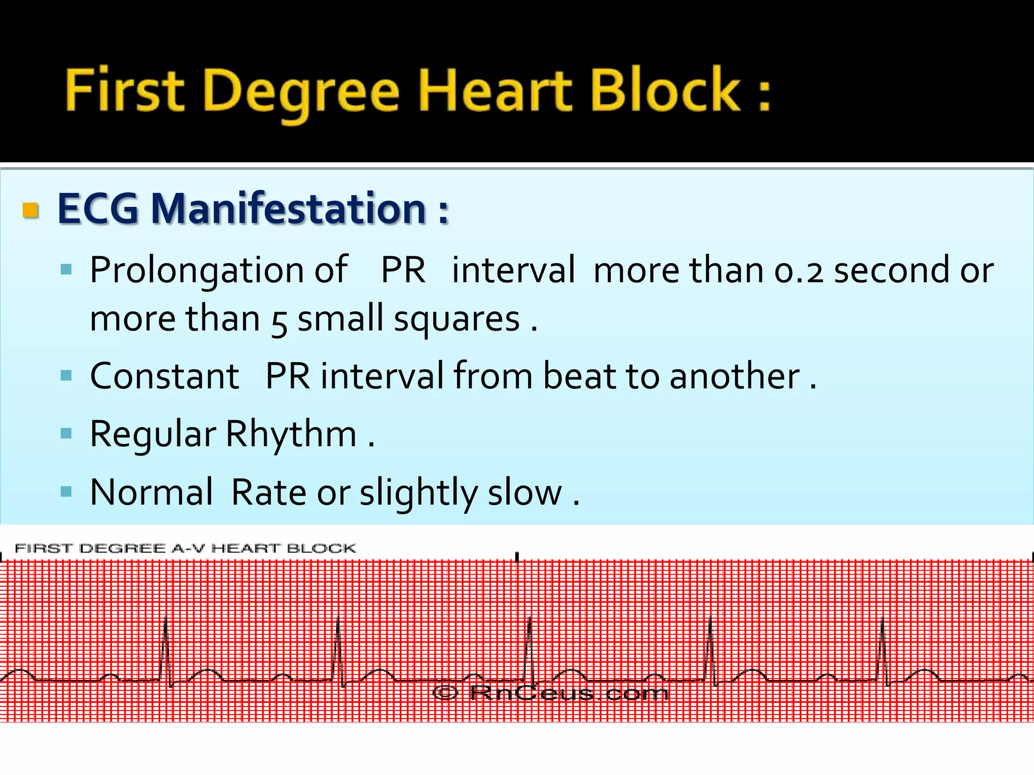 Heart block | PPTX