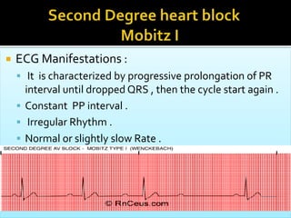 Heart block | PPTX