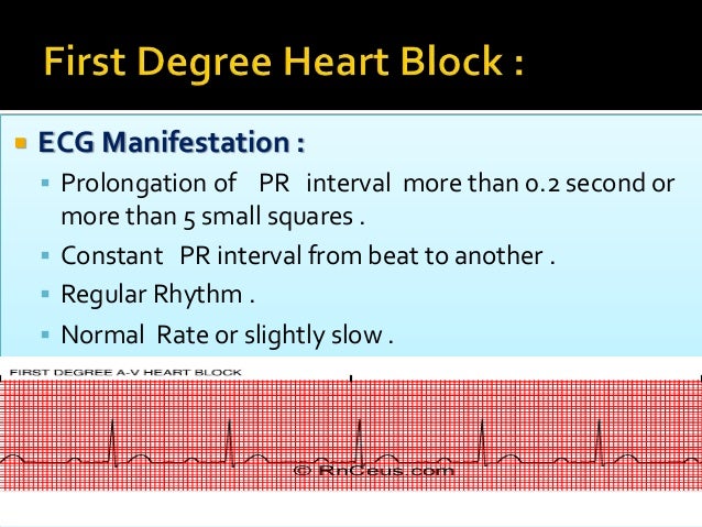 Heart block