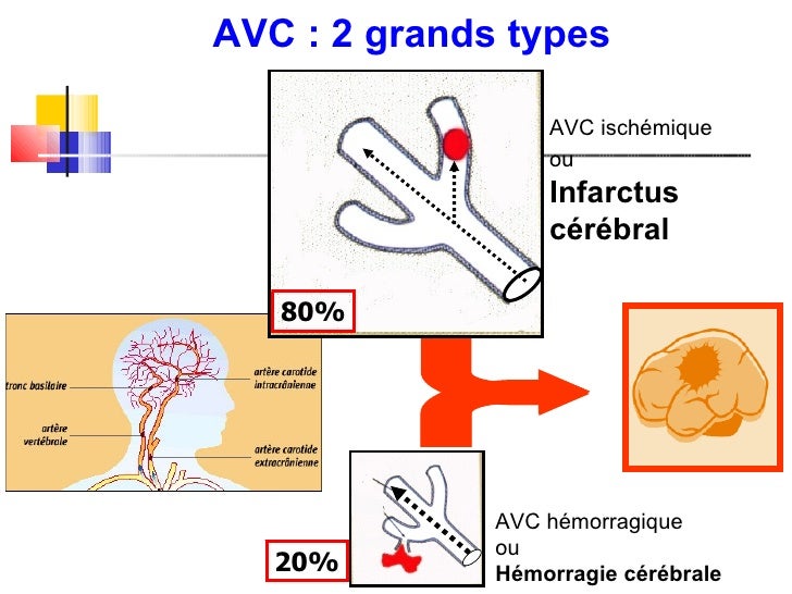 "AVC" par Mathieu ZUBER, Neurologue