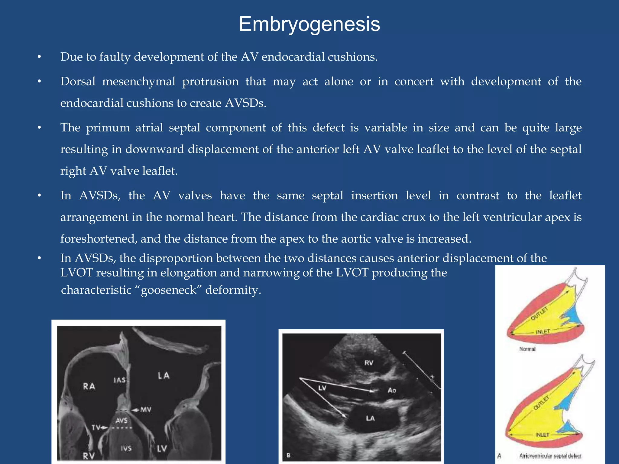Av canal defect | PPTX