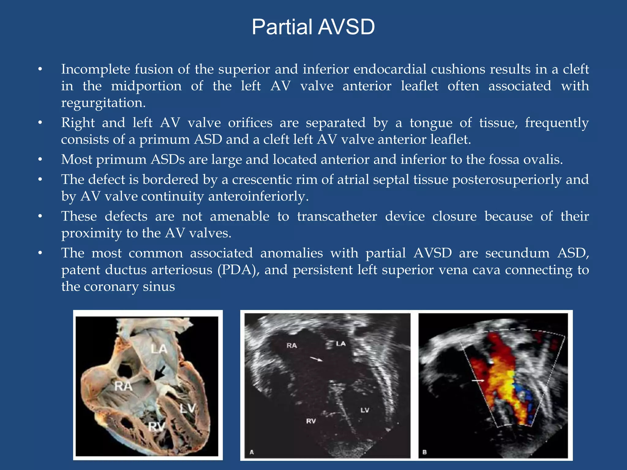 Av canal defect | PPTX