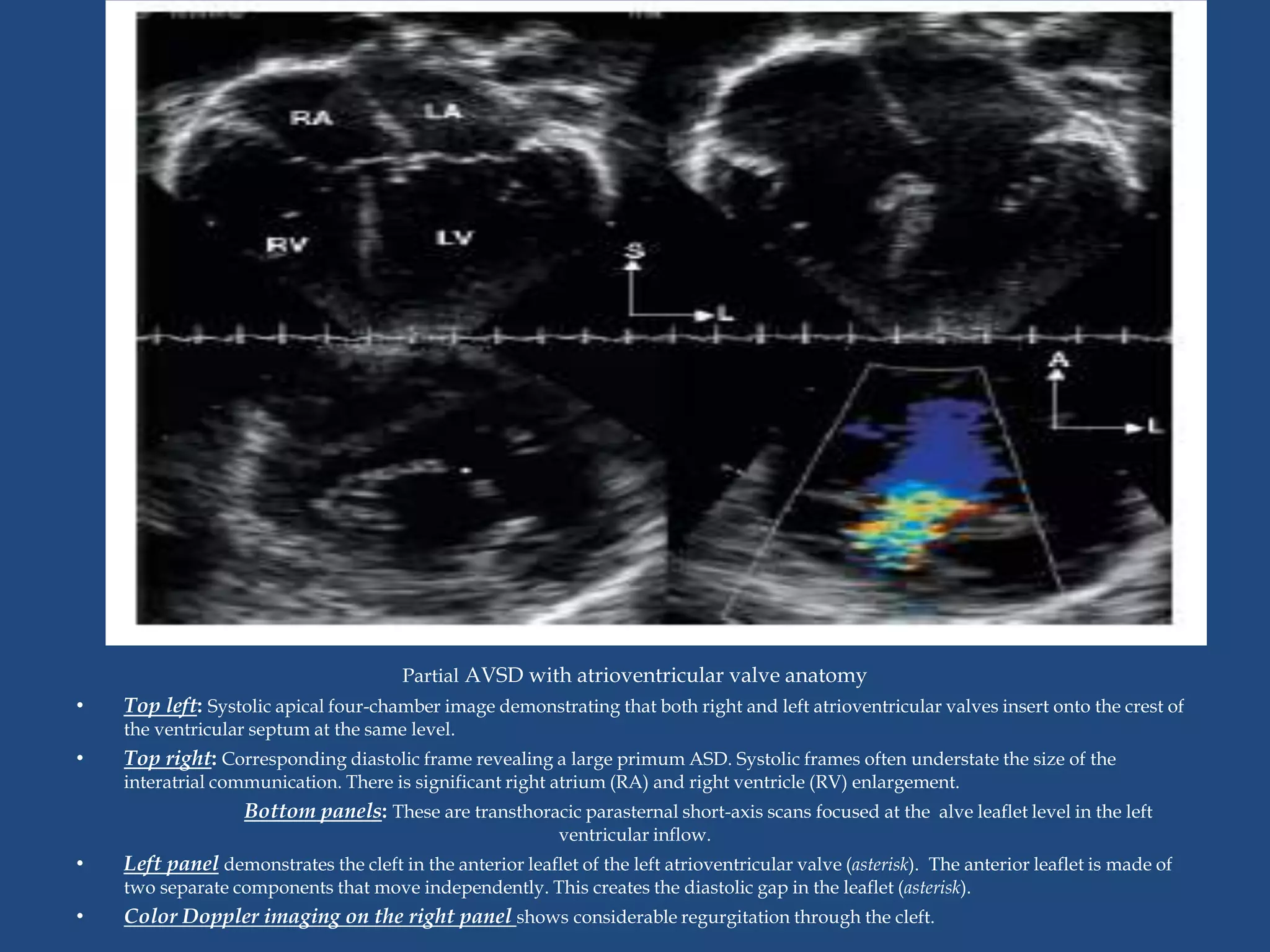 Av canal defect | PPTX