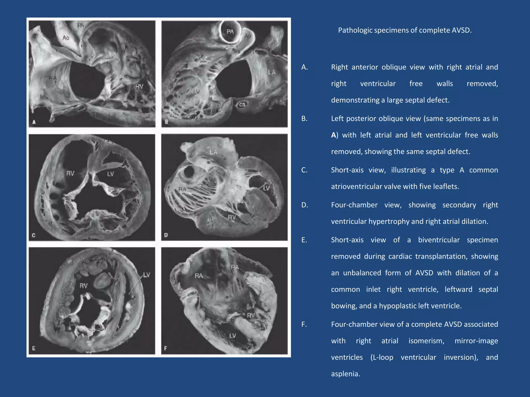 Av canal defect | PPTX