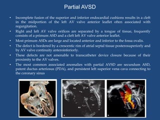 Av canal defect | PPTX