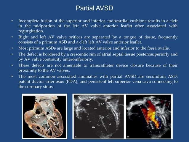 Av canal defect | PPTX