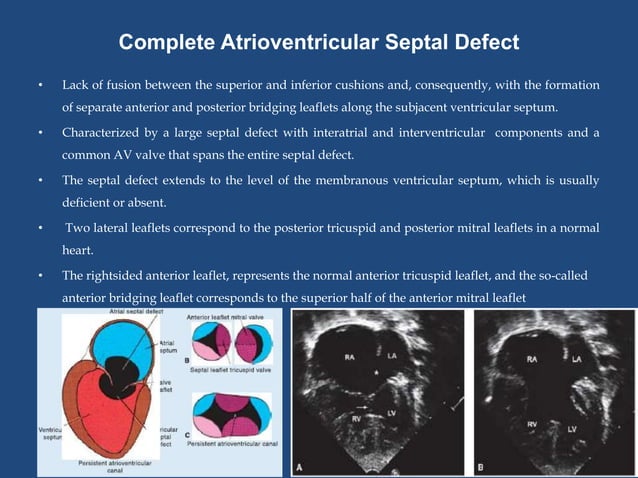 Av canal defect | PPTX