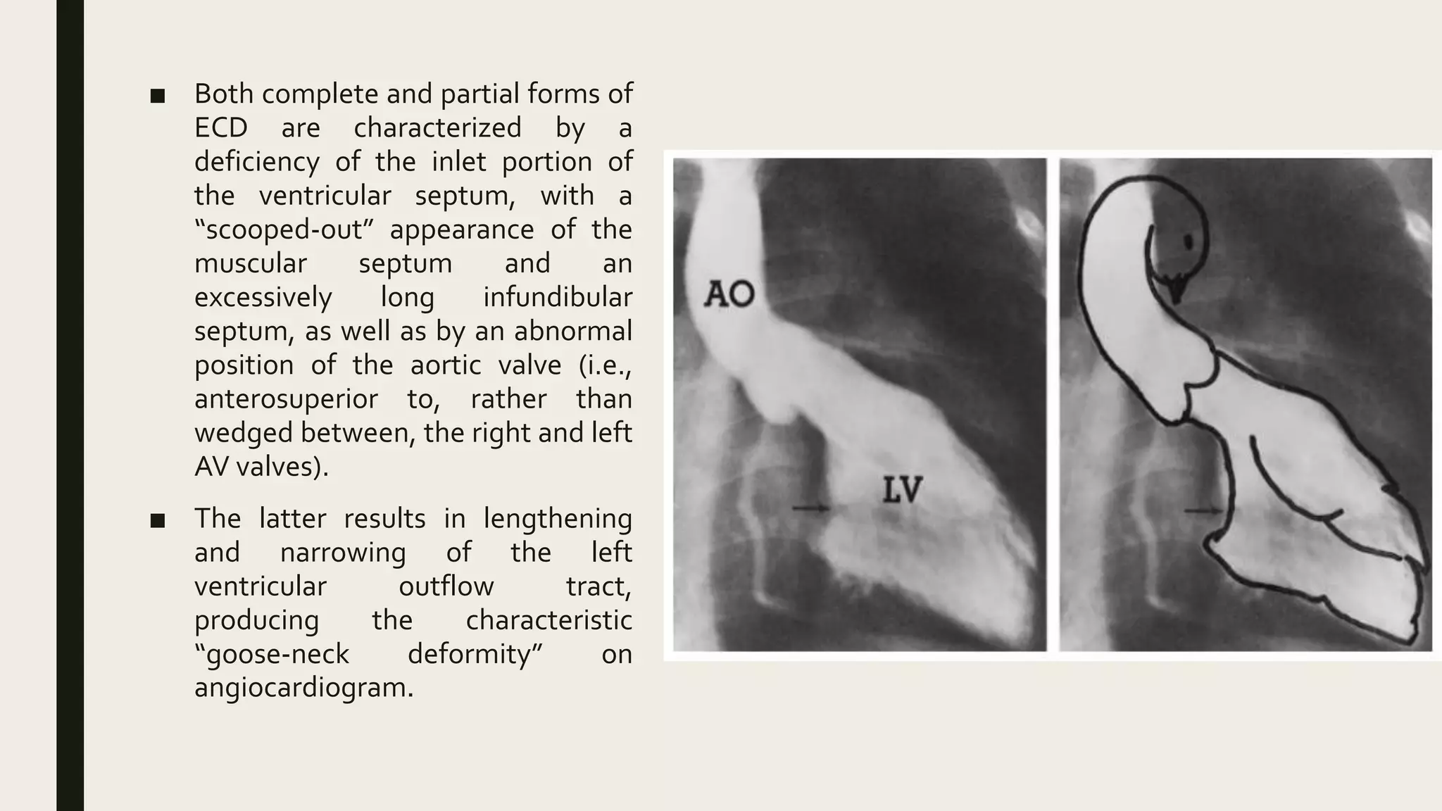 Av canal defect | PPTX