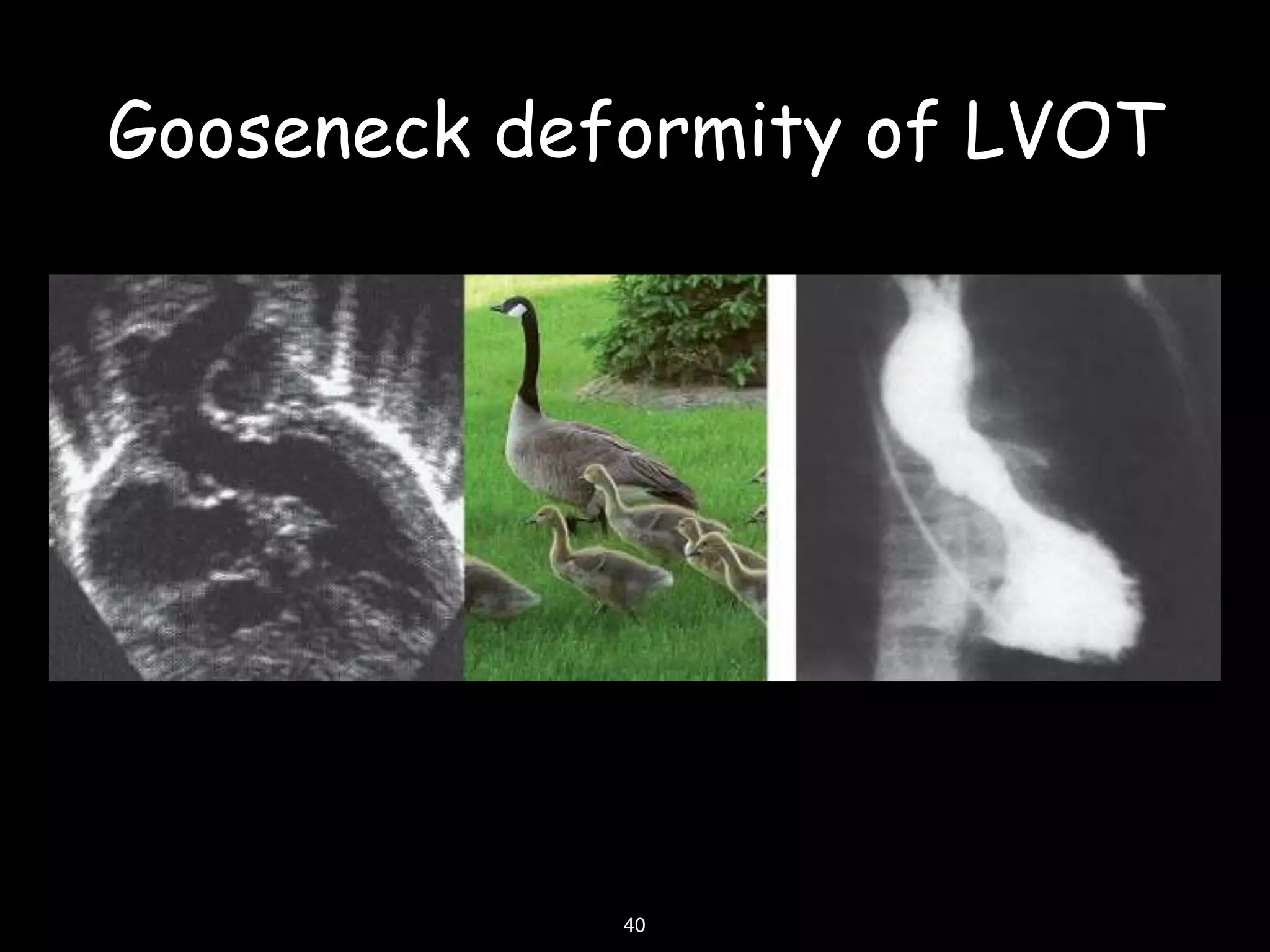 Atrioventricular Septal Defect Ppt