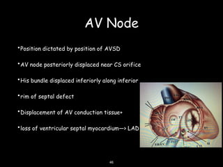 ATRIOVENTRICULAR SEPTAL DEFECT | PPTX