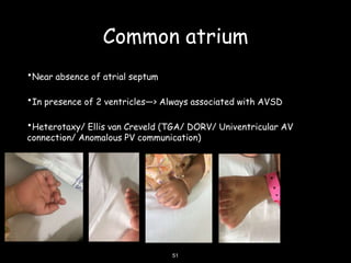 ATRIOVENTRICULAR SEPTAL DEFECT | PPTX