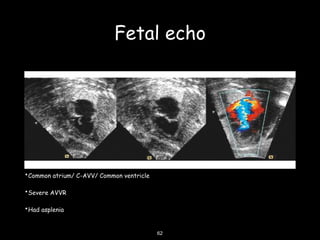 ATRIOVENTRICULAR SEPTAL DEFECT | PPTX