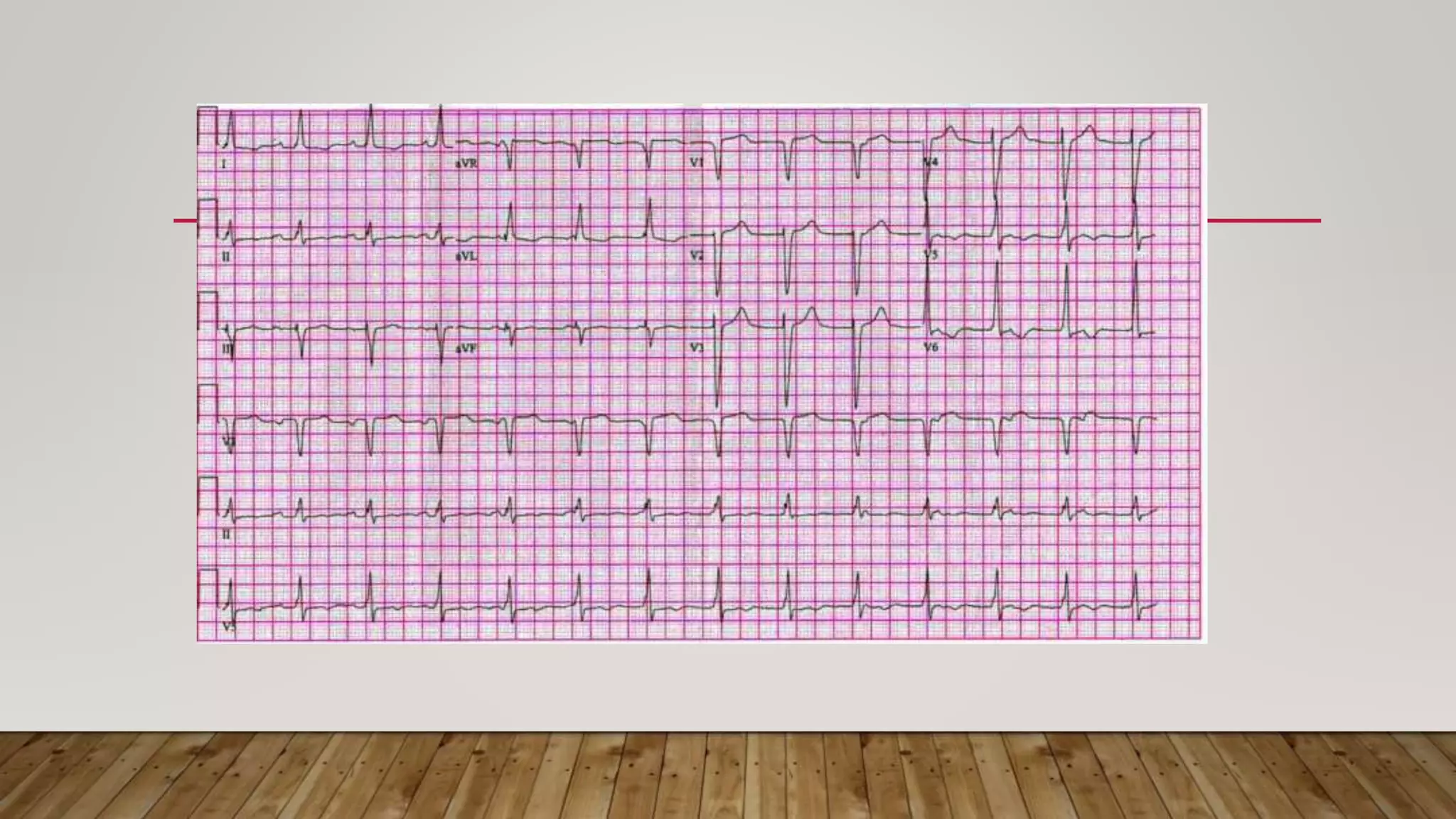 AV dissociation.pptx | Heart and Cardiovascular Diseases | Diseases and ...
