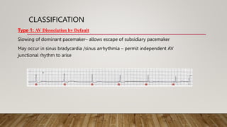 AV dissociation.pptx
