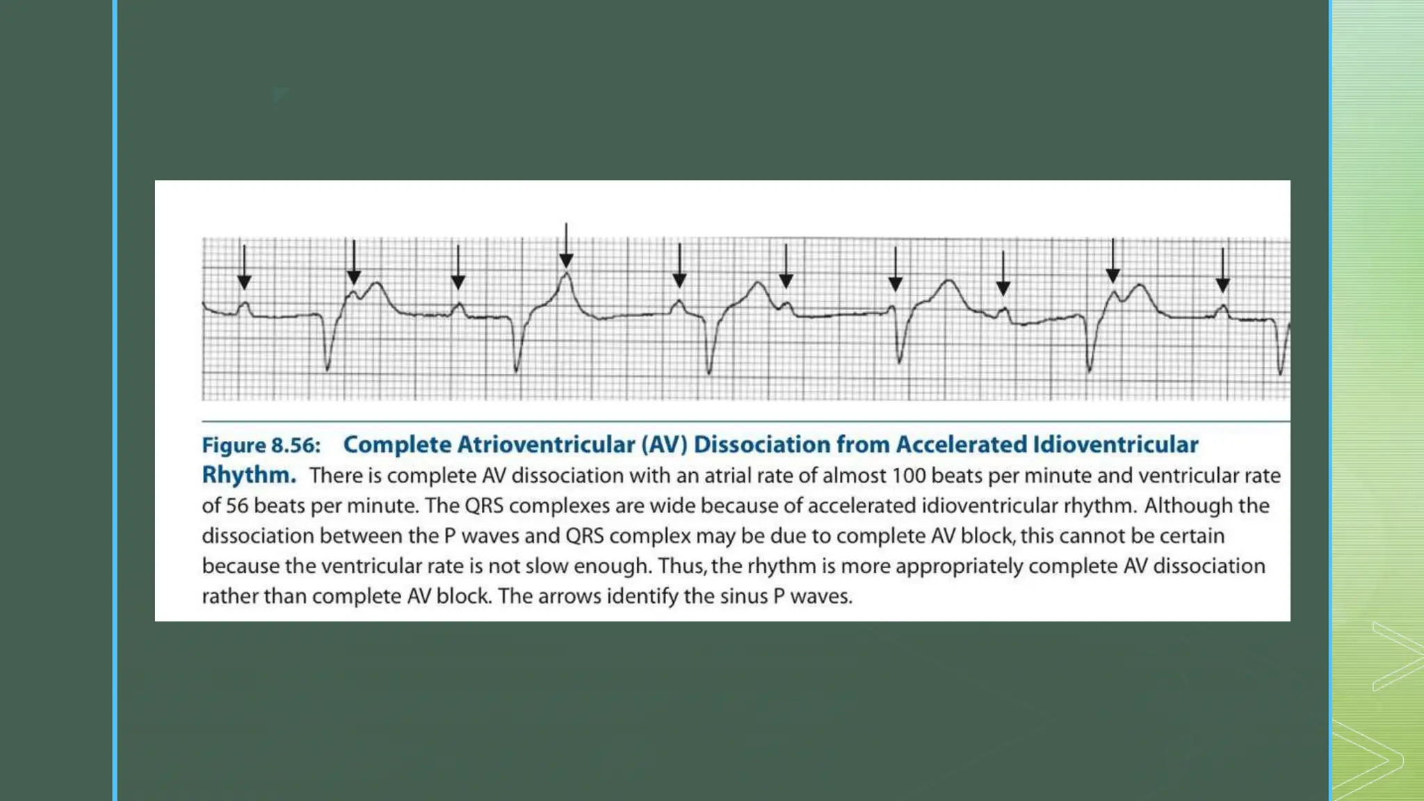 Atrio-Ventricular Dissociation - causes with ECG examples | PPTX ...