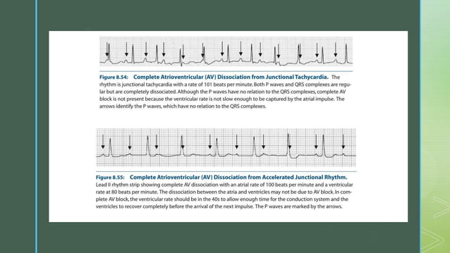 Atrio-Ventricular Dissociation - causes with ECG examples | PPTX