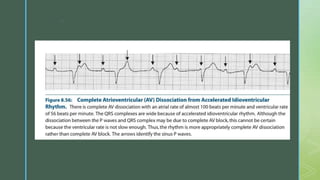 Atrio-Ventricular Dissociation - causes with ECG examples | PPTX ...