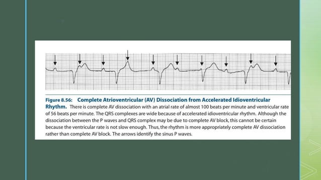Atrio-Ventricular Dissociation - causes with ECG examples | PPTX