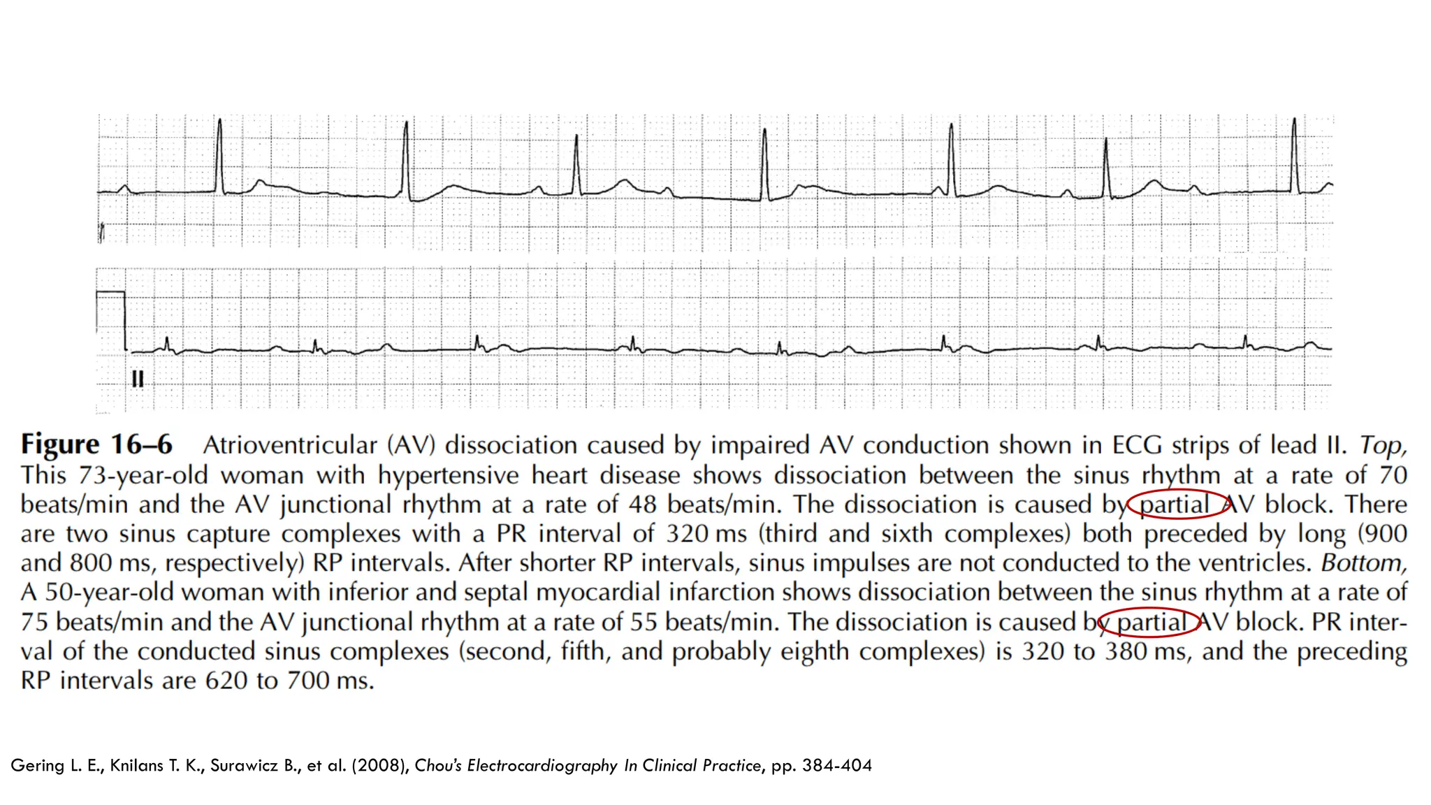 ATRIOVENTRICULAR DISSOCIATION - Phân li nhĩ thất | PPT