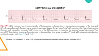 ATRIOVENTRICULAR DISSOCIATION - Phân li nhĩ thất | PPT
