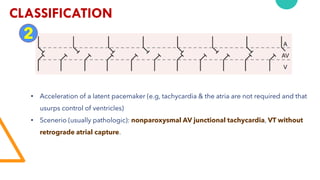 ATRIOVENTRICULAR DISSOCIATION - Phân li nhĩ thất | PPT