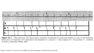 ATRIOVENTRICULAR DISSOCIATION - Phân li nhĩ thất | PPT