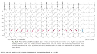 ATRIOVENTRICULAR DISSOCIATION - Phân li nhĩ thất | PPT