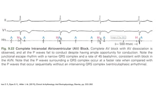 ATRIOVENTRICULAR DISSOCIATION - Phân li nhĩ thất | PPT