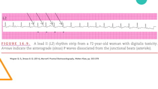 ATRIOVENTRICULAR DISSOCIATION - Phân li nhĩ thất | PDF