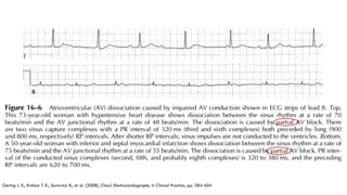ATRIOVENTRICULAR DISSOCIATION - Phân li nhĩ thất | PPT