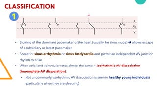 ATRIOVENTRICULAR DISSOCIATION - Phân li nhĩ thất | PPT