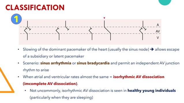 ATRIOVENTRICULAR DISSOCIATION - Phân li nhĩ thất | PPT