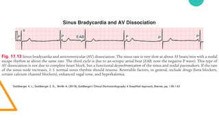 ATRIOVENTRICULAR DISSOCIATION - Phân li nhĩ thất | PPT