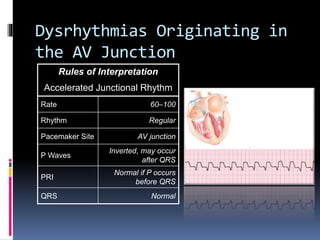 Av dysrhythmias | PPTX