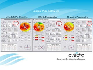 Avedro | PDF