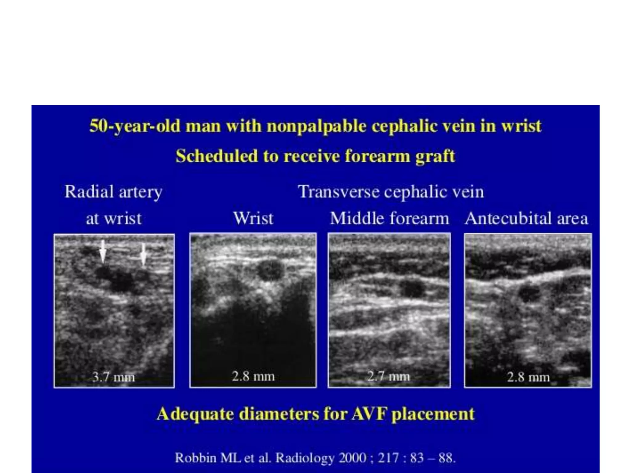 Avf | PPT
