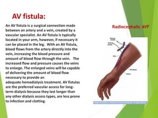 arterio - veous fistula | PDF