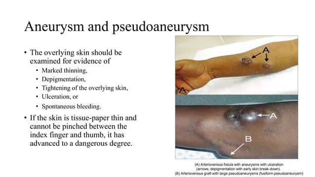 Arterio-Venous Access examination | PPTX