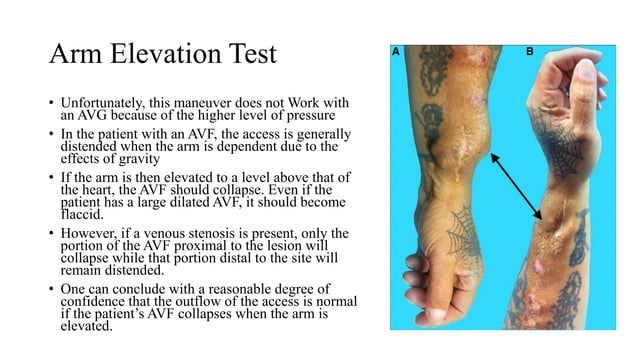 Arterio-Venous Access examination | PPTX
