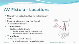 AV Fistula | PDF