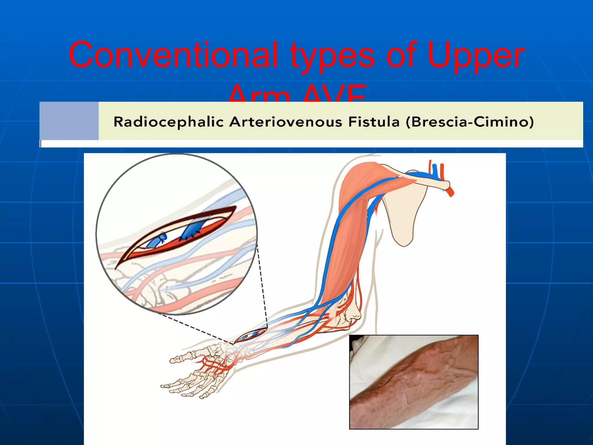 Av fistula examination - dr. tarek fayez | PPT