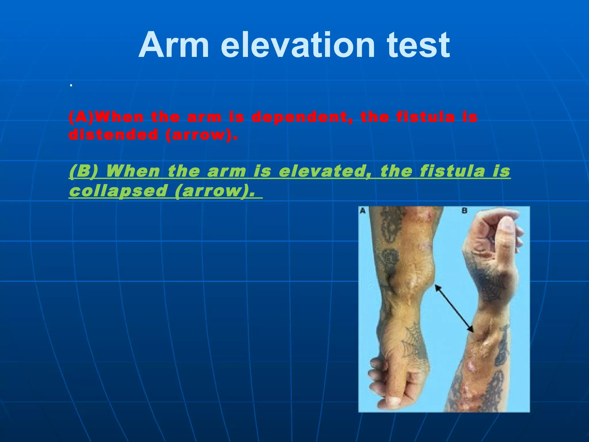 Av fistula examination - dr. tarek fayez | PPT