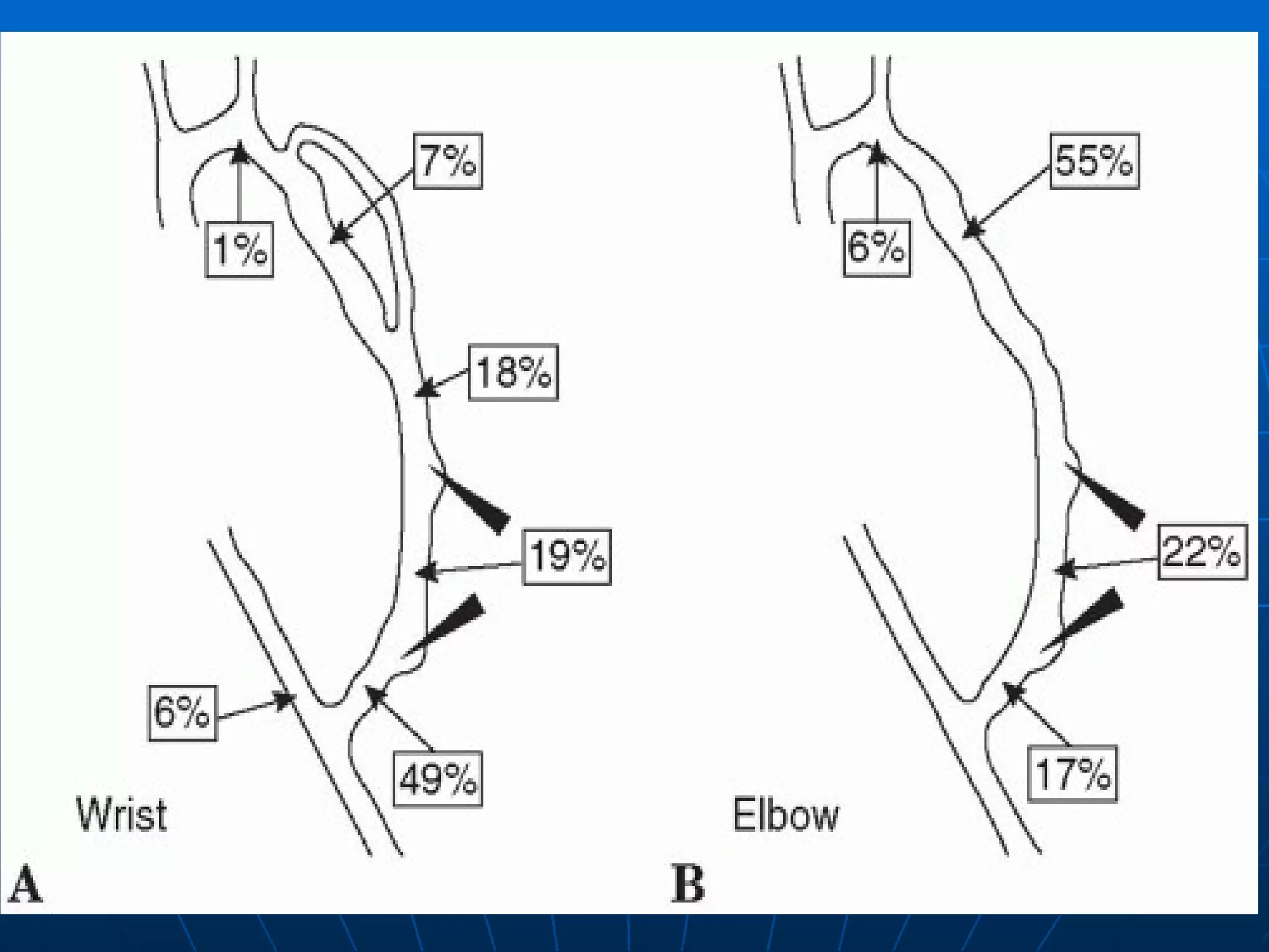 Av fistula examination - dr. tarek fayez | PPT