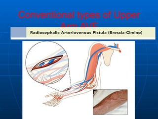 Av fistula examination - dr. tarek fayez | PPT