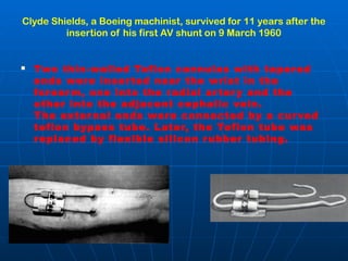 Av fistula examination - dr. tarek fayez | PPT