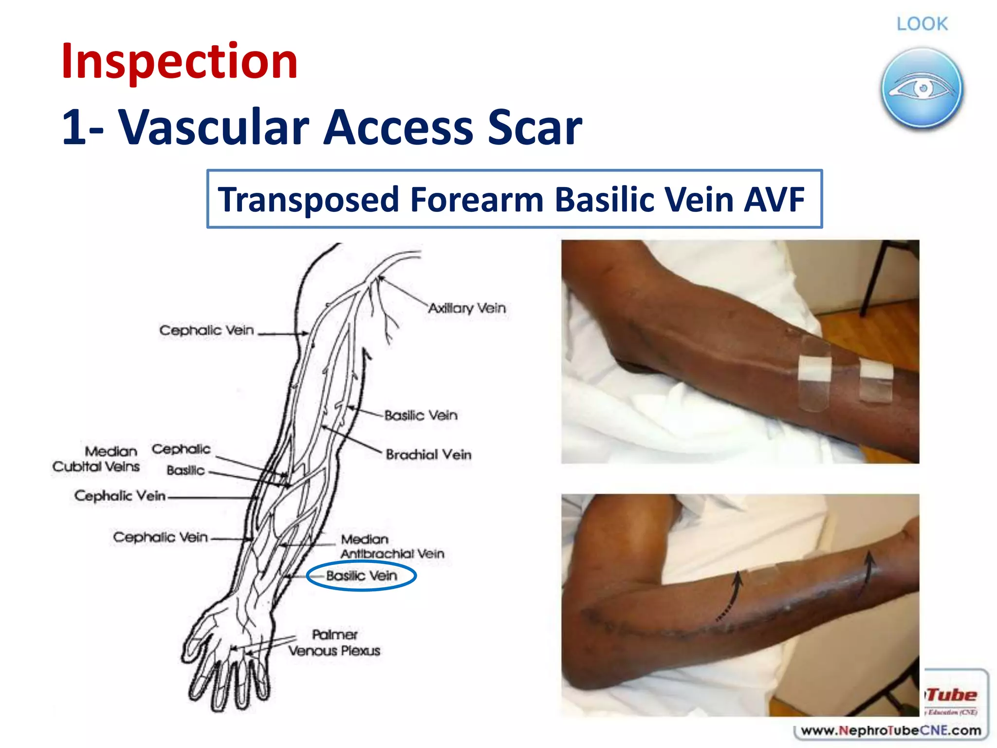 How to examine AVF in 10 minutes - Dr. Gawad | PPTX