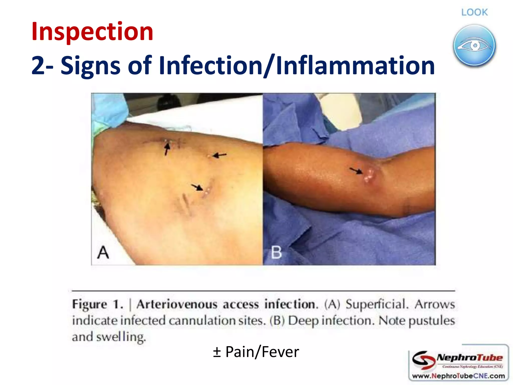 How to examine AVF in 10 minutes - Dr. Gawad | PPTX