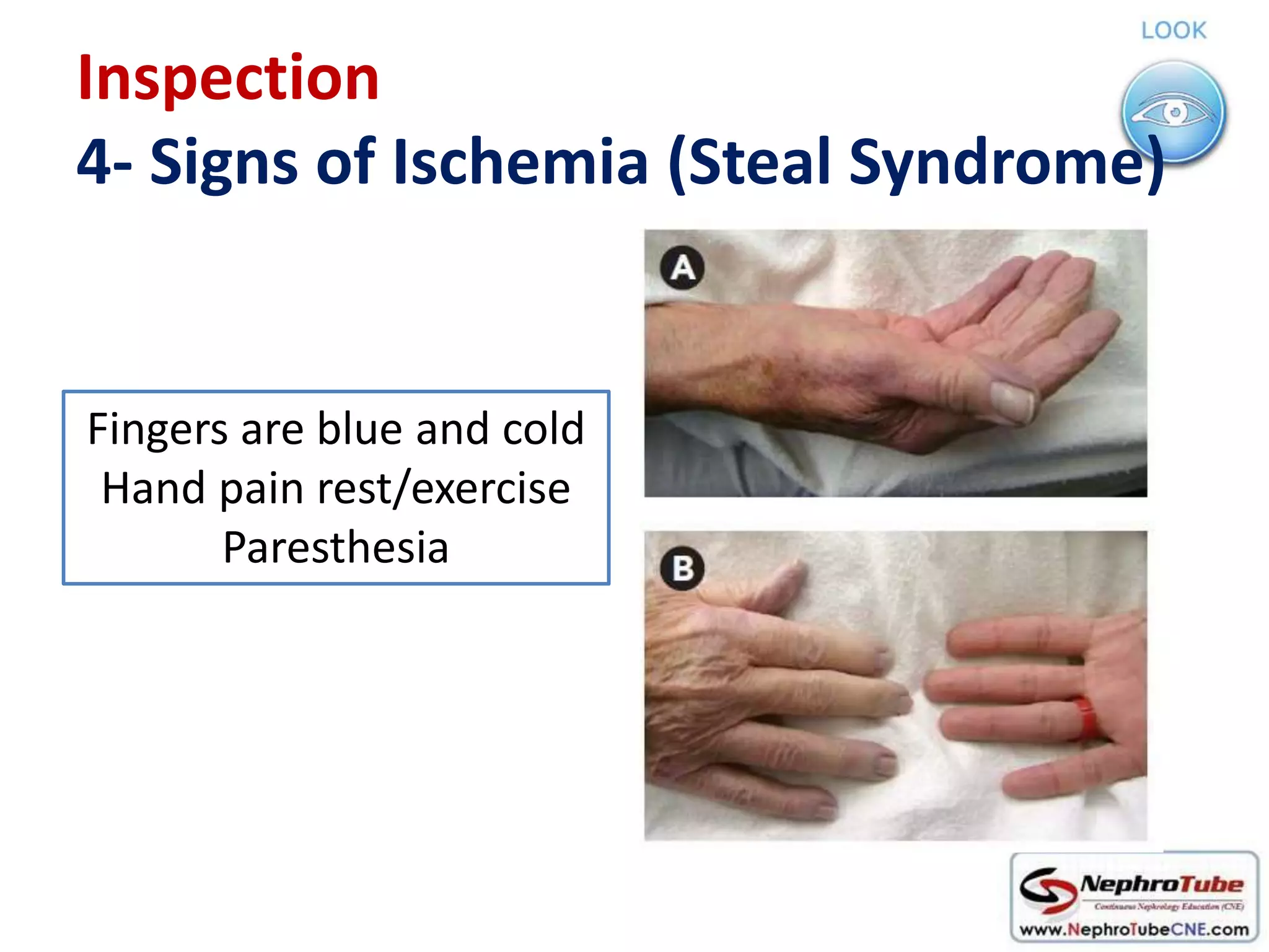 How to examine AVF in 10 minutes - Dr. Gawad | PPTX