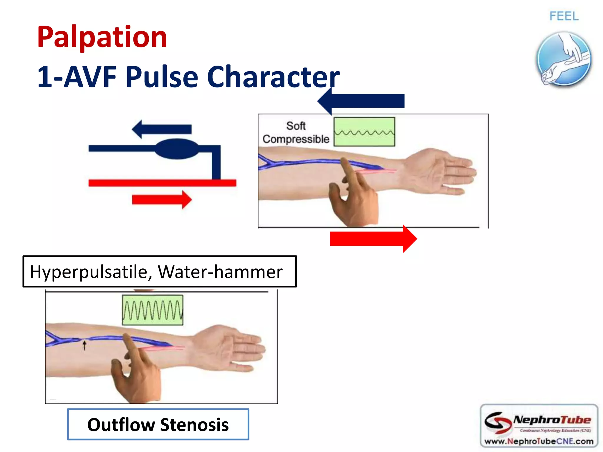 How to examine AVF in 10 minutes - Dr. Gawad | PPTX