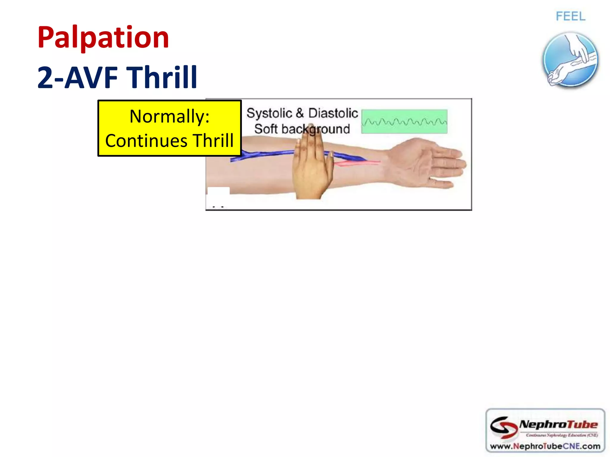 How to examine AVF in 10 minutes - Dr. Gawad | PPTX | Blood Disorders ...